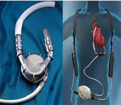 Ventricular Assist Devices (VAD) - Dr. Pravin Kulkarni